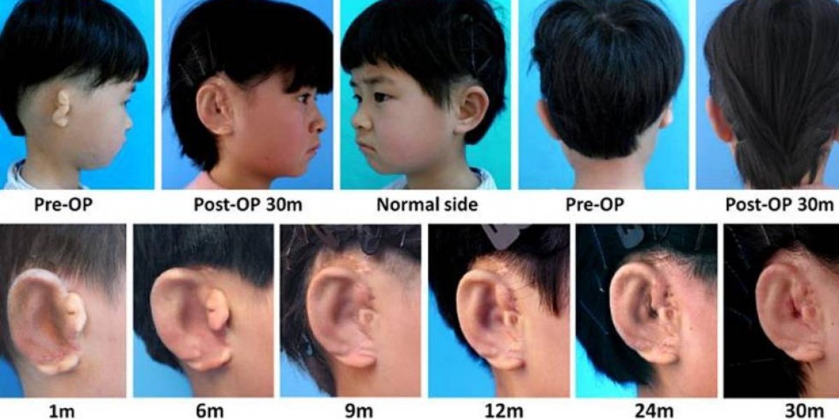 Tecnología China 3D permite implantar orejas | Robotica