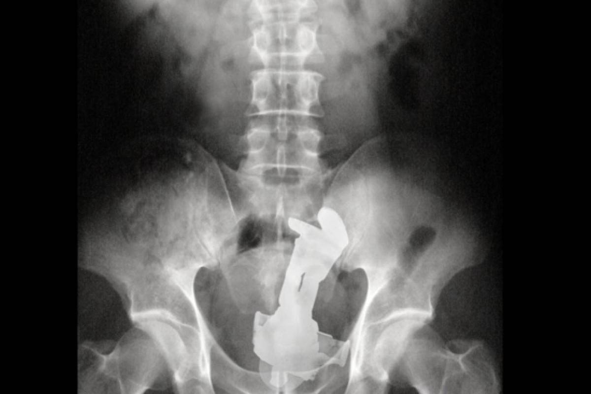 Insólito libro muestra 100 casos de obstrucción intestinal con objetos ...